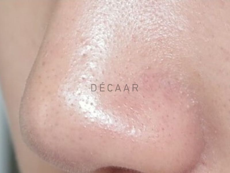 #Mụn Cám Ở Mũi Có Mùi Hôi: Nguyên Nhân Và Cách Xử Lý